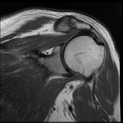 Acromioclavicular Joint (ACJ) - London Sports Orthopaedics