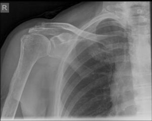 Acromioclavicular Joint (ACJ) - London Sports Orthopaedics