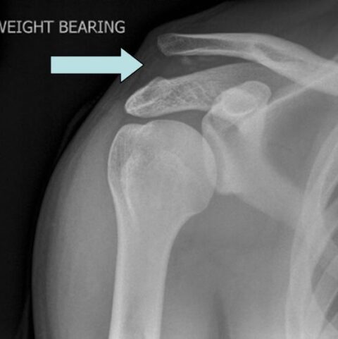 Acromioclavicular Joint (ACJ) - London Sports Orthopaedics