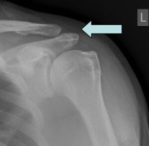 Acromioclavicular Joint (ACJ) - London Sports Orthopaedics