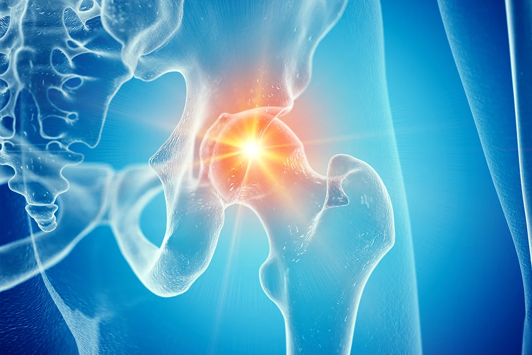 Hip Resurfacing - London Sports Orthopaedics