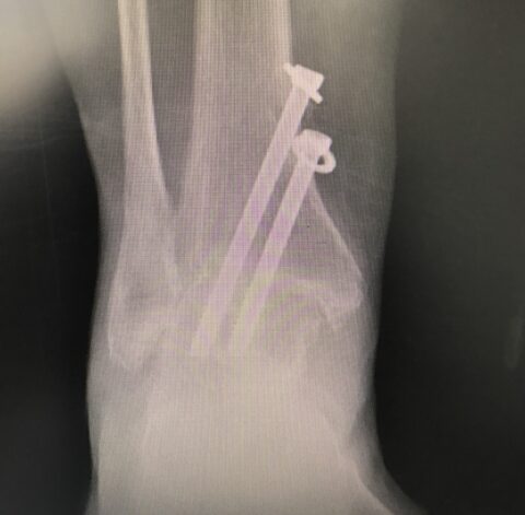 Ankle Fusion (Arthrodesis) - London Sports Orthopaedics