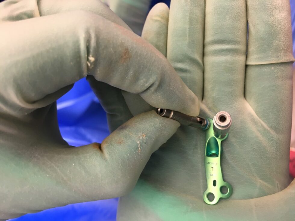 Big Toe Fusion - London Sports Orthopaedics