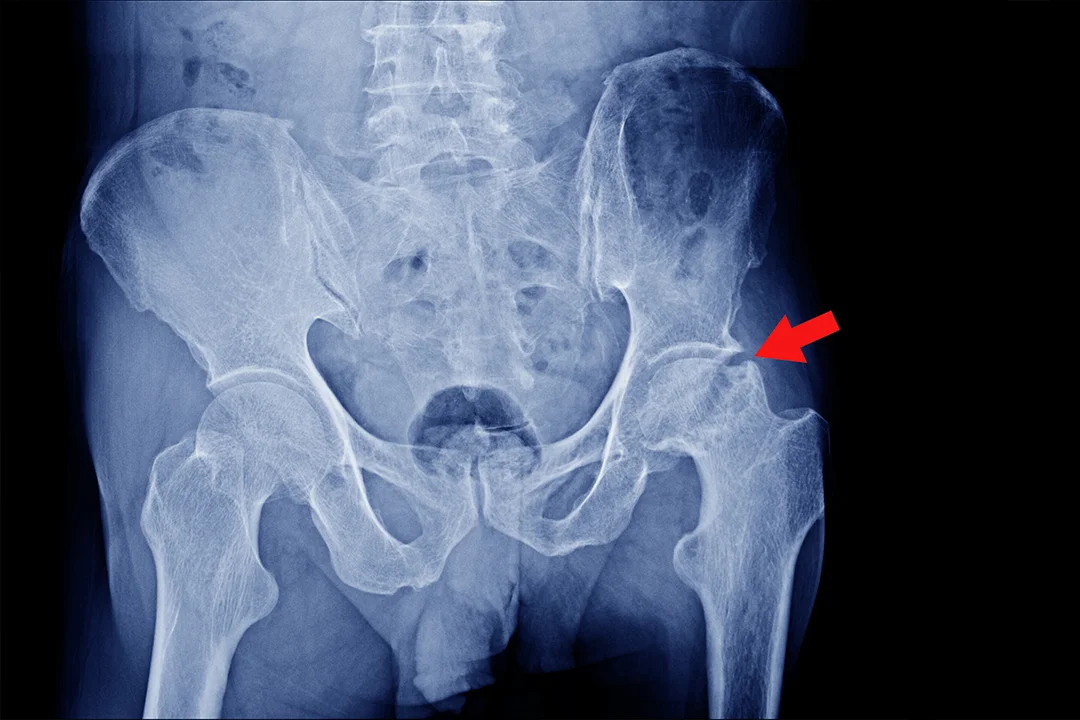 Trochanteric Bursitis X Ray Multimodality Imaging Of Greater