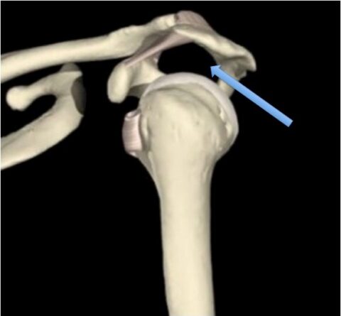 Subacromial Decompression - London Sports Orthopaedics